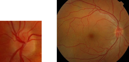 Le glaucome (GCAO) : symptômes, diagnostic et traitement