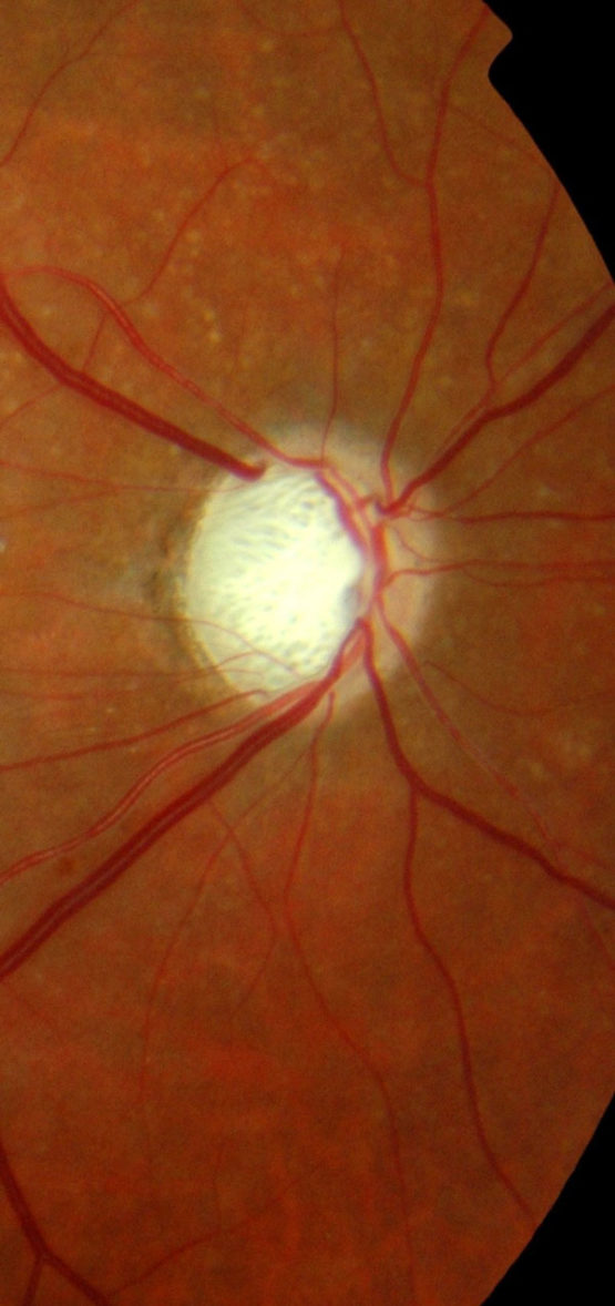 Le glaucome (GCAO) : symptômes, diagnostic et traitement
