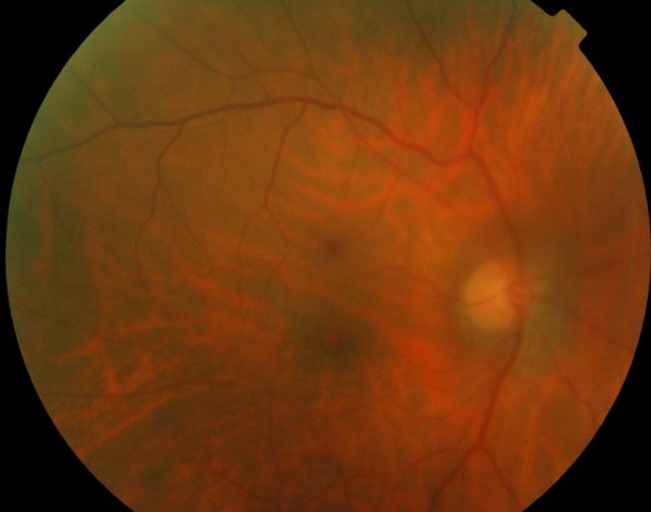 La myopie forte : diagnostic et traitement - Clinique Honoré Cave