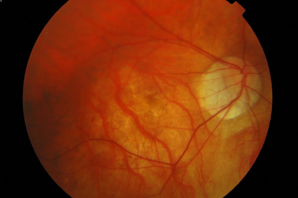 La myopie forte : diagnostic et traitement - Clinique Honoré Cave
