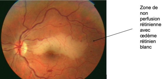 Occlusion de la veine centrale de la rétine : diagnostic et traitement
