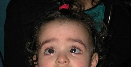 Diagnostic et traitement du strabisme chez l'enfant - Clinique Honoré Cave