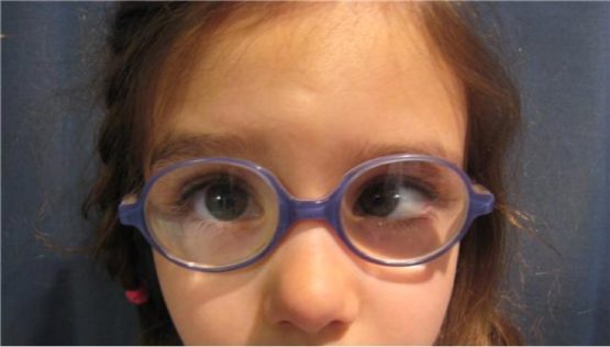 Diagnostic et traitement du strabisme chez l'enfant - Clinique Honoré Cave