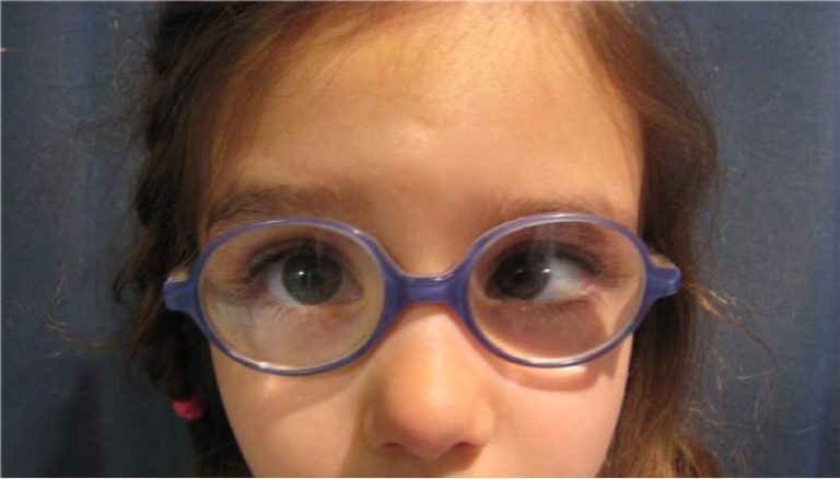 Diagnostic et traitement du strabisme chez l'enfant - Clinique Honoré Cave