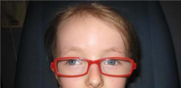 Diagnostic et traitement du strabisme chez l'enfant - Clinique Honoré Cave