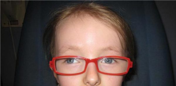 Diagnostic et traitement du strabisme chez l'enfant - Clinique Honoré Cave