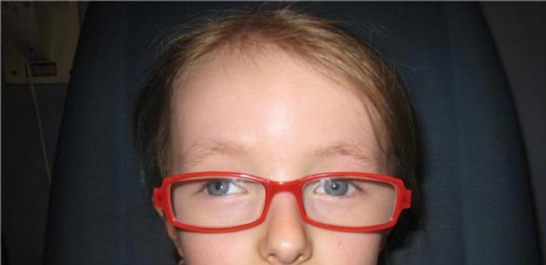 Diagnostic et traitement du strabisme chez l'enfant - Clinique Honoré Cave