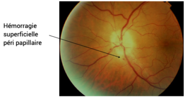 Névrite Optique Ischémique Antérieure Aiguë : diagnostic et traitement