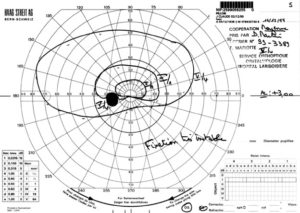 Névrite Optique Ischémique Antérieure Aiguë – Clinique Honoré Cave