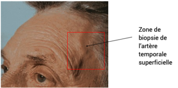 Névrite Optique Ischémique Antérieure Aiguë : diagnostic et traitement