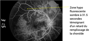 Névrite Optique Ischémique Antérieure Aiguë : diagnostic et traitement