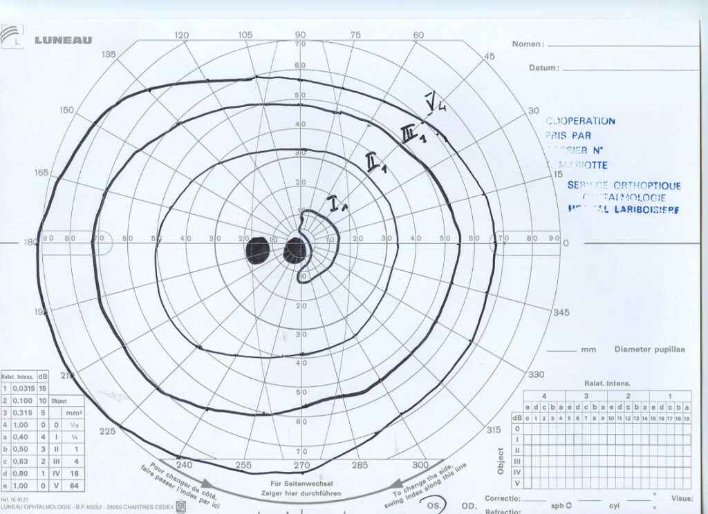 Anomalie de la vision d'apparition brutale : diagnostic et traitement