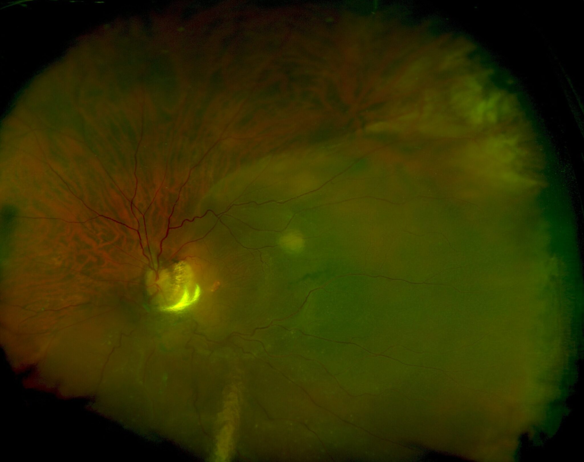 Anomalie de la vision d'apparition brutale : diagnostic et traitement