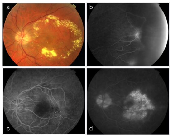 Traitement des télangiectasies maculaires et angiomatoses