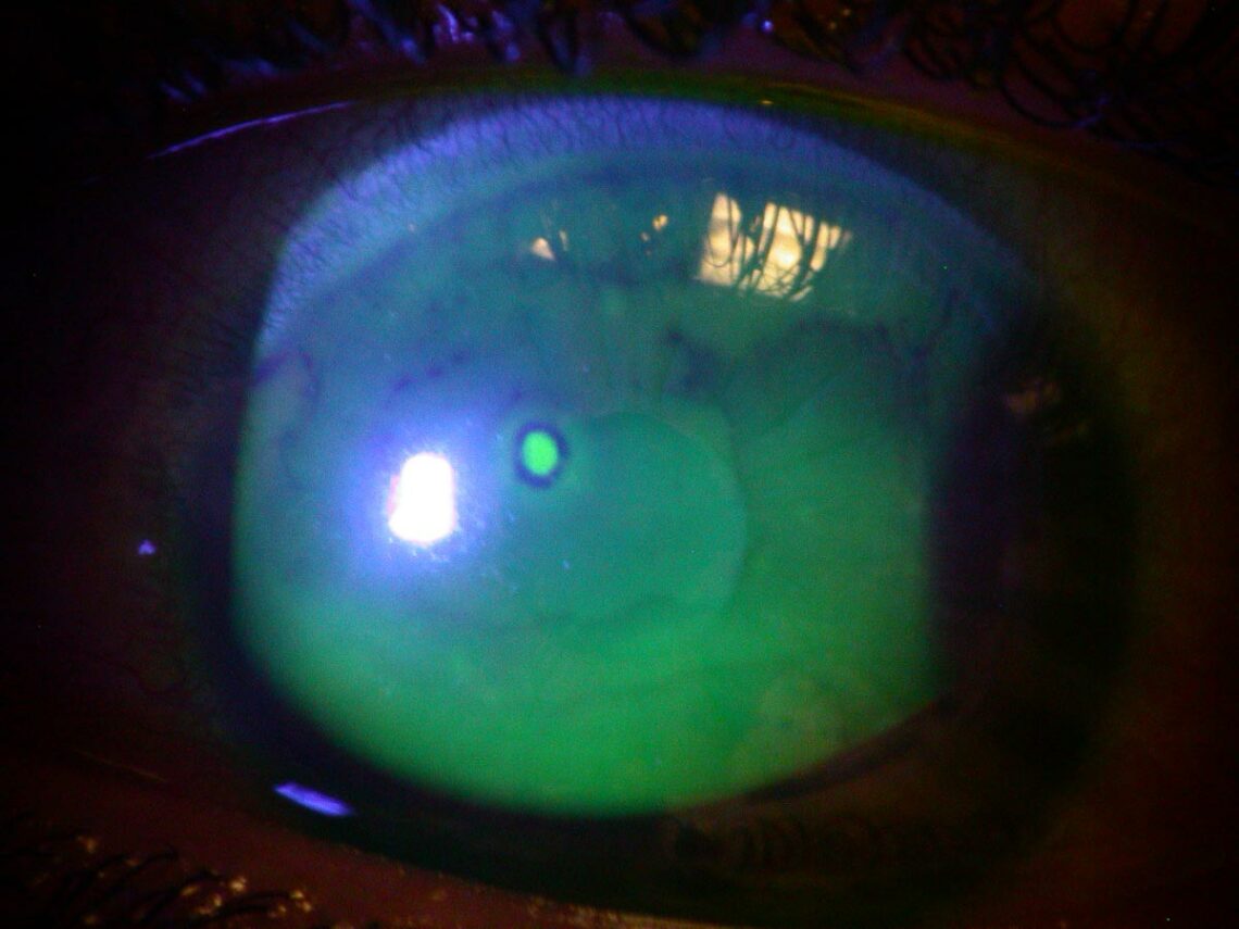 Traumatismes et plaies oculaires : traitement et chirurgie - Clinique ...