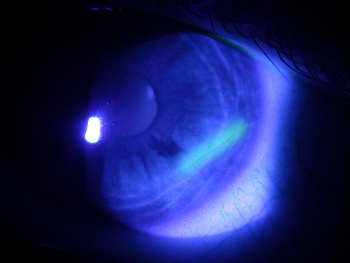 Traumatismes et plaies oculaires : traitement et chirurgie - Clinique ...