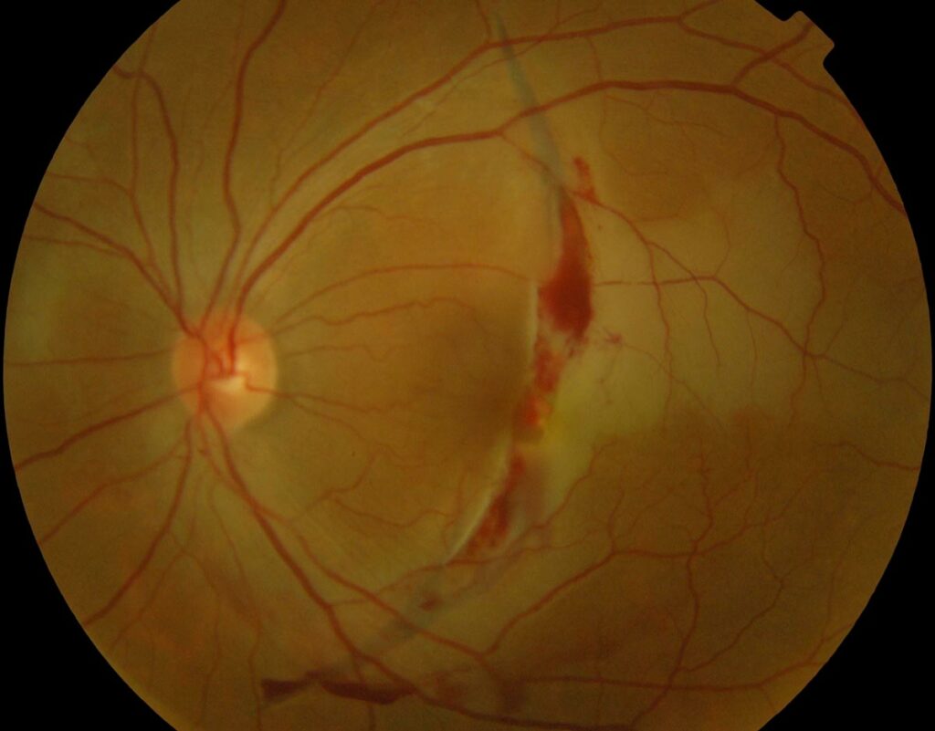 Traumatismes et plaies oculaires : traitement et chirurgie - Clinique ...