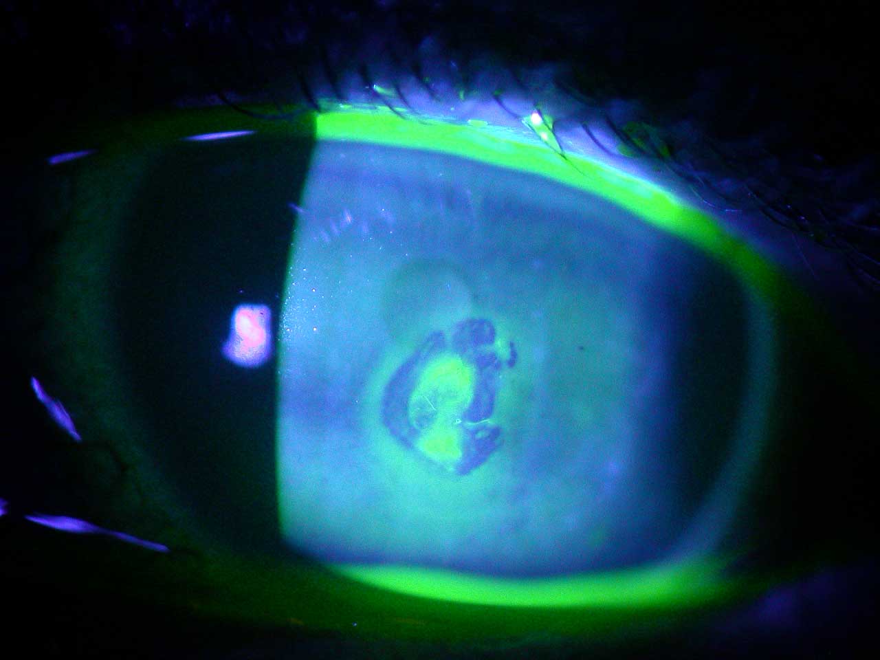 Examen ophtalmologique des yeux à la Clinique Honoré Cave de Montauban