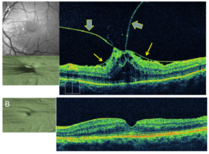 Membrane épirétinienne et trou maculaire : diagnostic et traitement