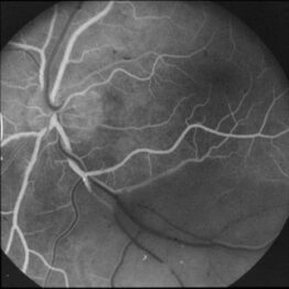 Occlusion artérielle rétinienne : diagnostic et traitements