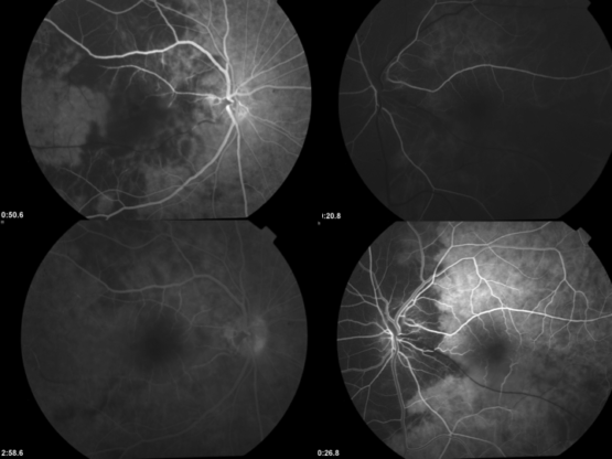 Occlusion artérielle rétinienne : diagnostic et traitements