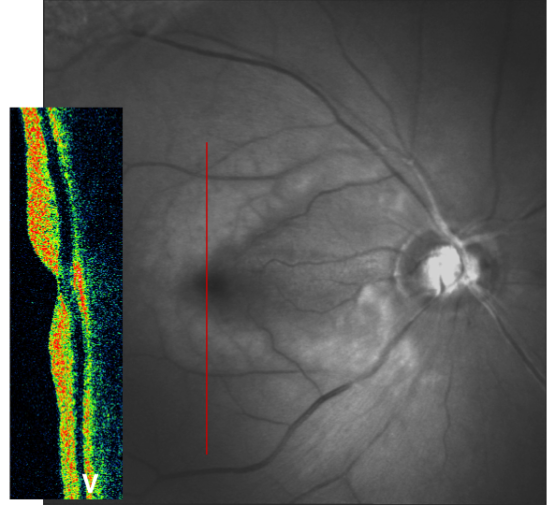 Occlusion artérielle rétinienne : diagnostic et traitements