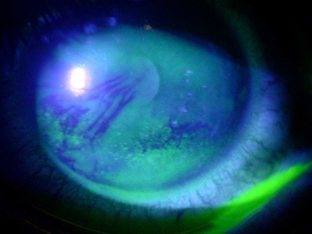 Oeil rouge et douloureux : diagnostic et traitement - Clinique Honoré Cave