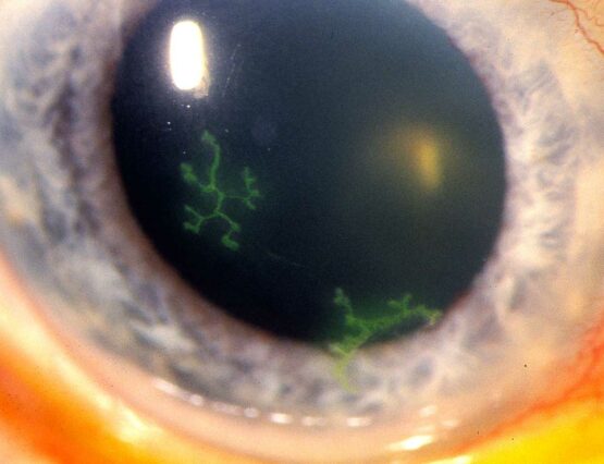 Oeil rouge et douloureux : diagnostic et traitement - Clinique Honoré Cave