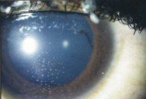 Oeil rouge et douloureux : diagnostic et traitement - Clinique Honoré Cave