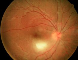 Oeil rouge et douloureux : diagnostic et traitement - Clinique Honoré Cave