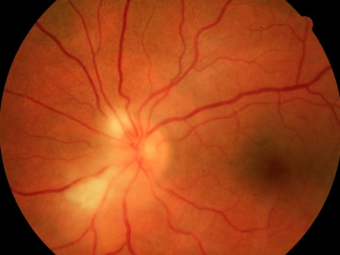 Oeil rouge et douloureux : diagnostic et traitement - Clinique Honoré Cave