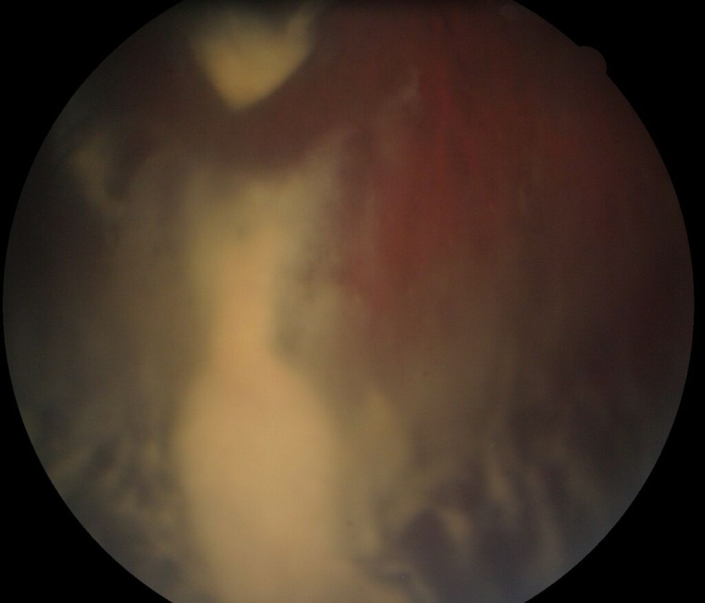 Oeil rouge et douloureux : diagnostic et traitement - Clinique Honoré Cave