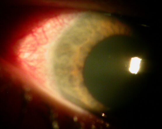 Oeil rouge et douloureux : diagnostic et traitement - Clinique Honoré Cave