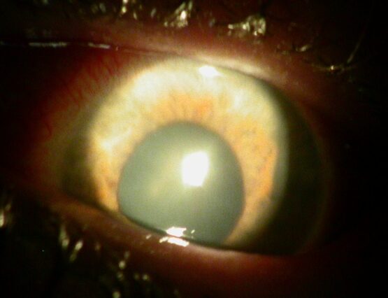 Oeil rouge et douloureux : diagnostic et traitement - Clinique Honoré Cave