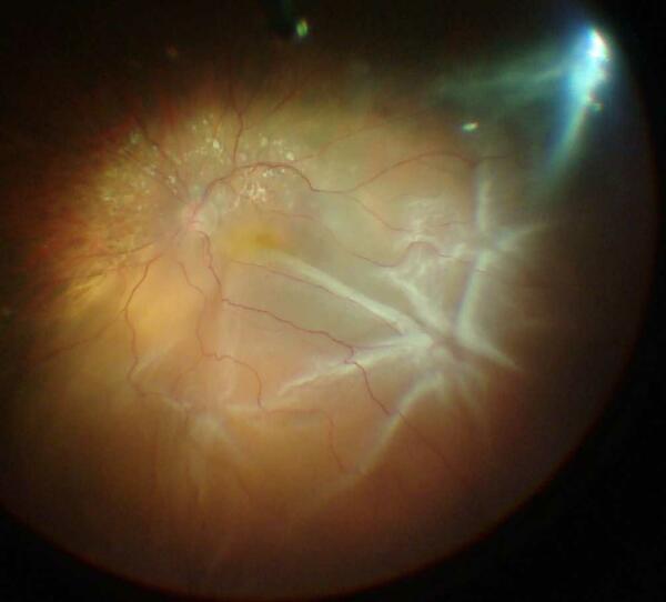 Décollement de rétine – Clinique Honoré Cave